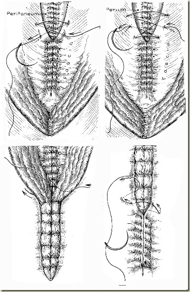 INFORMASI REPRODUKSI: TEHNIK LAPAROTOMI